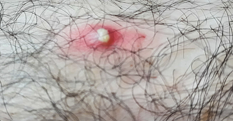 Boils: Causes, Symptoms, Treatment | Dermatocare