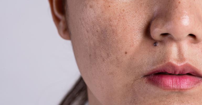 Uneven Skin Tone: A Dermatologist’s Guide to Causes and Treatment ...