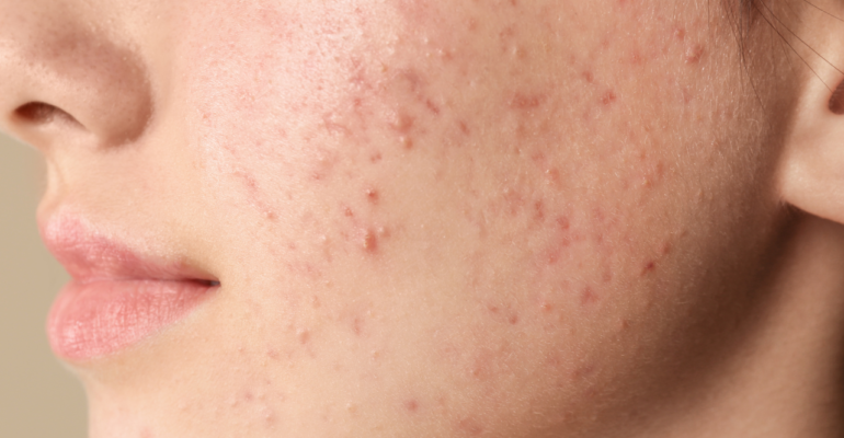 Anti-Acne Ingredients: A Complete Dermatologist Guide | Dermatocare