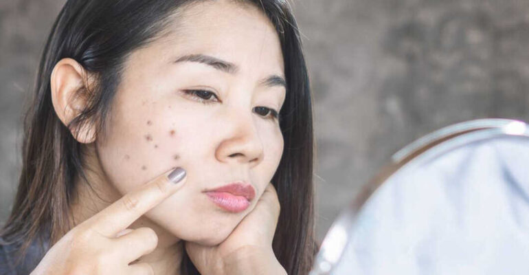 15 types of Spots on the face: Are they Dangerous? | Dermatocare