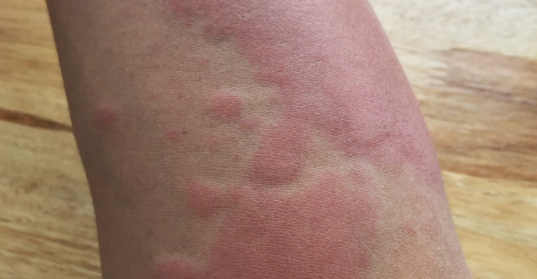 Hives (Urticaria): Types, Causes, Treatment & Relief - Dermatocare