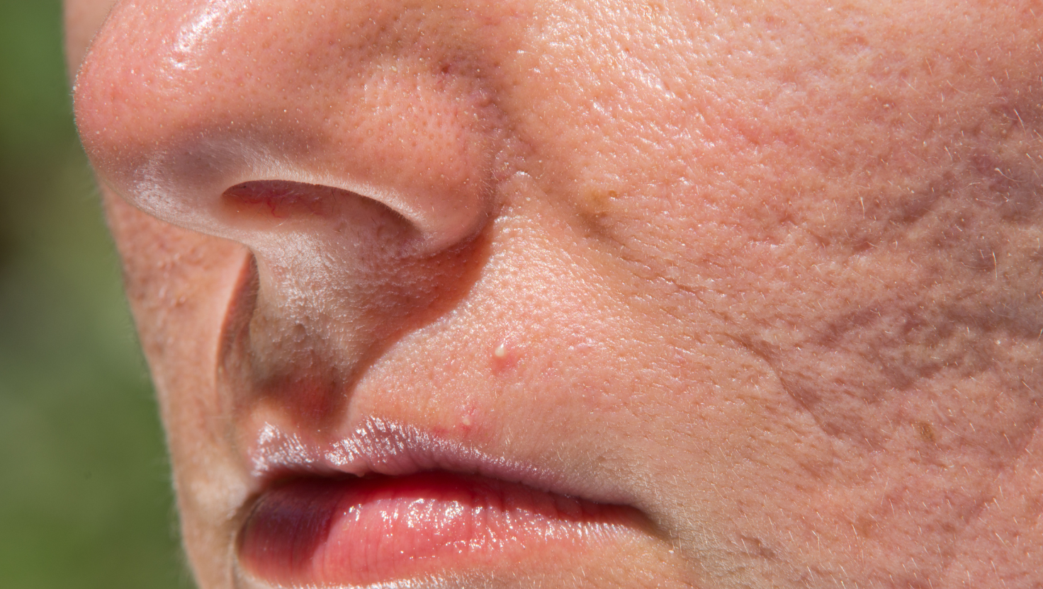 6 Type of acne scars and their treatment: Dermatologist Guide | Dermatocare