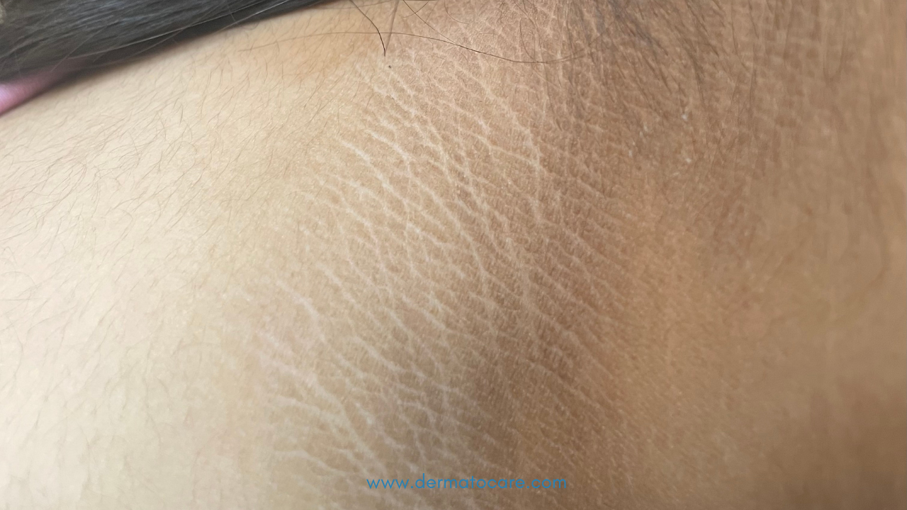 Acanthosis Nigricans Groin